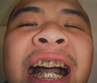 Where to Get Gold Teeth