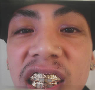 How Much Do Gold Teeth Cost?